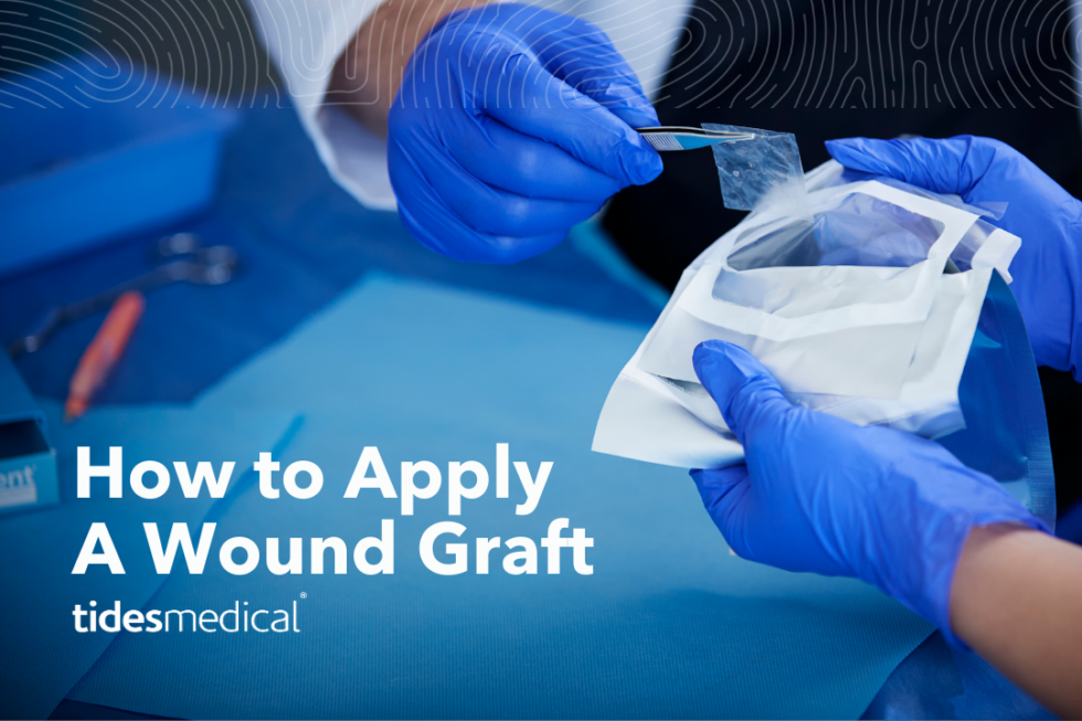 Amniotic Tissue Graft - How To Apply A Wound Graft - Tides Medical