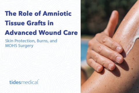 Amniotic Tissue Grafts | Advanced Wound Care | Mohs Surgery - Tides Medical